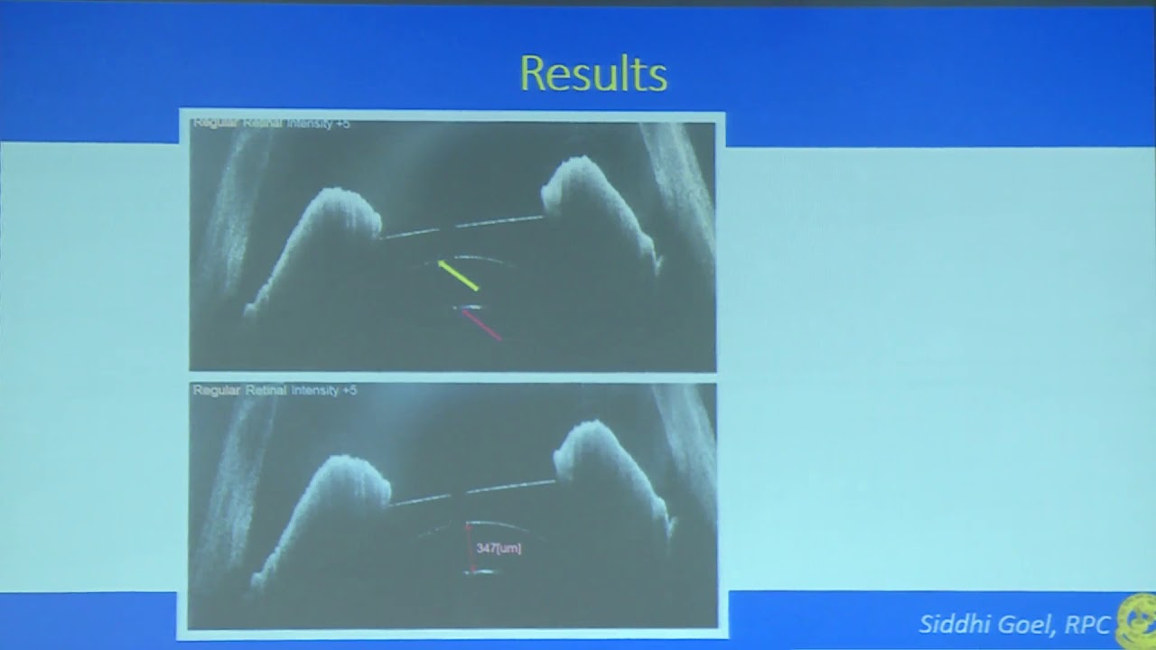 AIOC2020 FP Ref Surgery Dr SIDDHI GOEL Assessment of Implantable ...