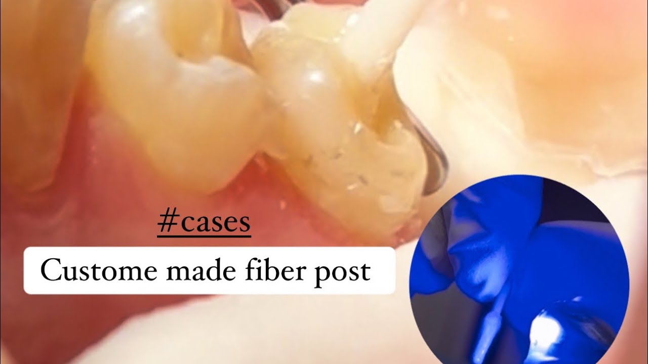Custom made fiber post technique - YouTube