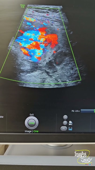 Morbidly Adherent Placenta And Central Placenta Previa Ultrasound