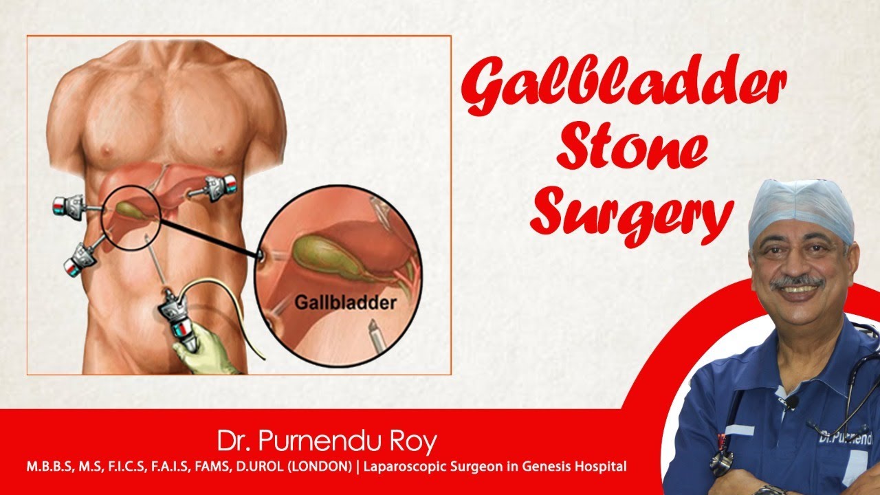 Gallbladder Stone Surgery | Laparoscopic Cholecystectomy | Dr. Purnendu ...