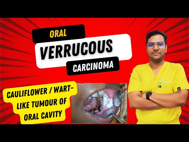 Verrucous Carcinoma Gums