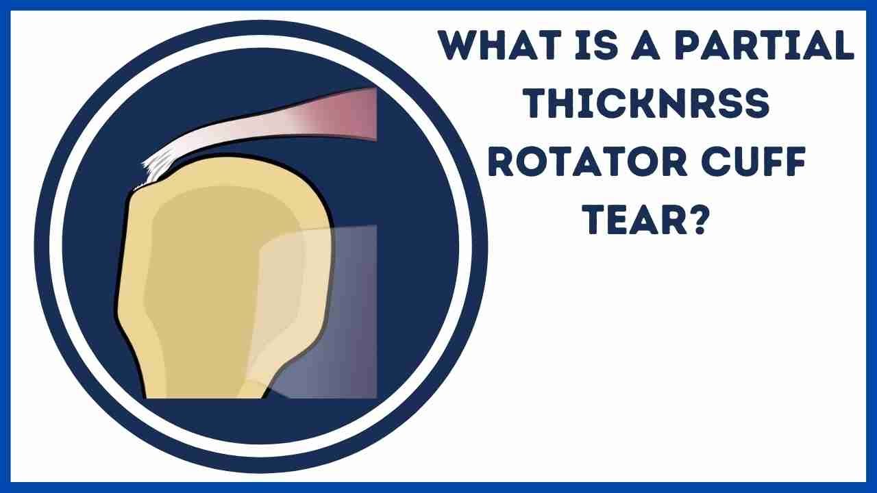 What is a partial thickness rotator cuff tear? - YouTube