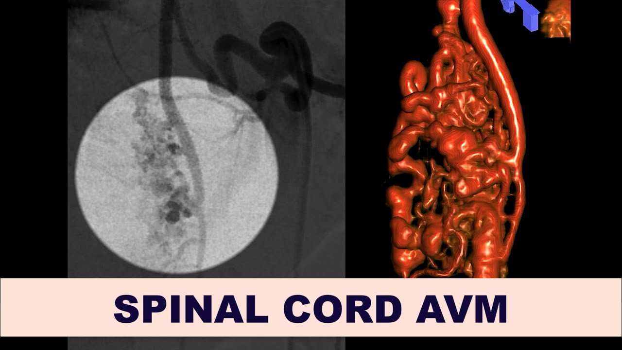 Spinal Cord AVM : Angiographic Anatomy - YouTube