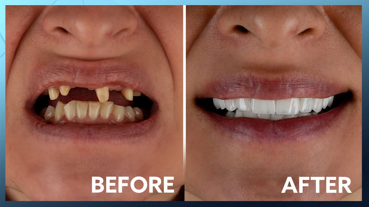 Unbelievable Smile Transformation: a New Yorker at Kristal Clinic - YouTube