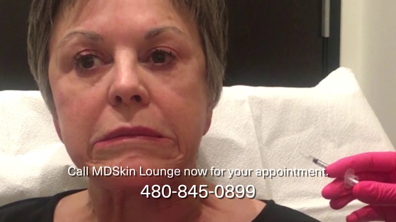 MDSkin Off Label Botox - YouTube