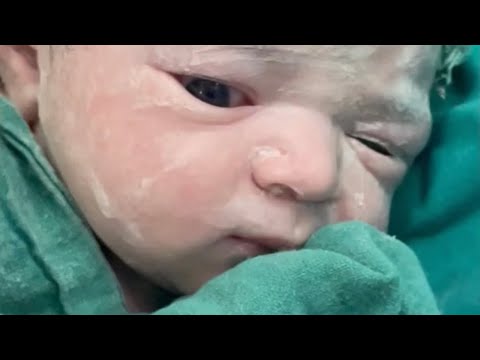 What is the composition of vernix caseosa ? - YouTube