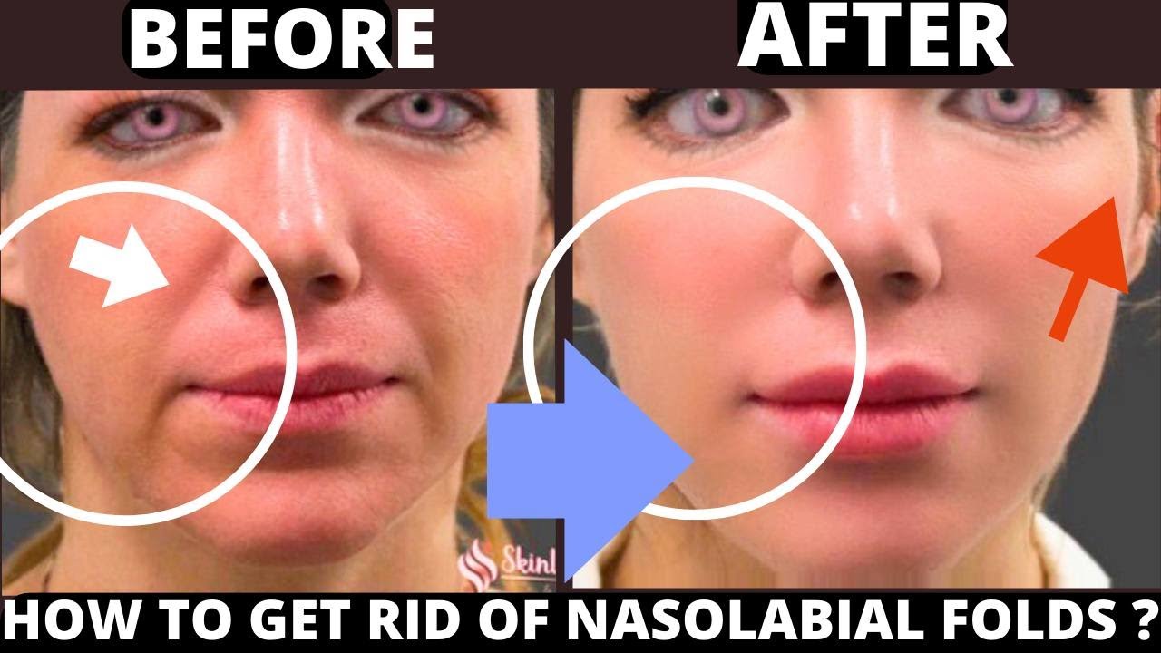 🛑 HOW TO GET RID OF SMILE LINES ? GET RID OF LAUGH LINES WITH FACE YOGA ...