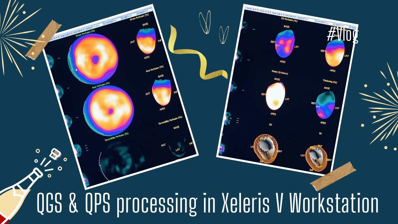 QGS/QPS MPI Processing : Cardiac processing in stress thallium test ...