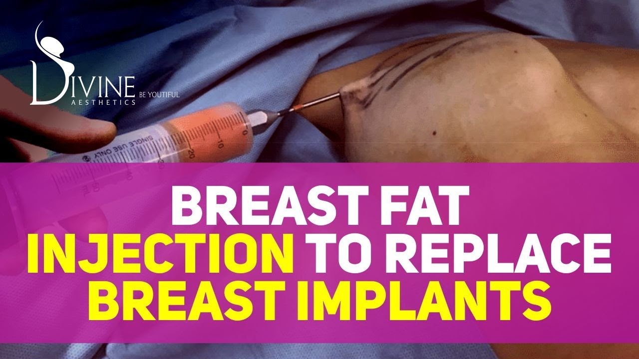 Breast Fat Injection to Replace Breast Implants - YouTube