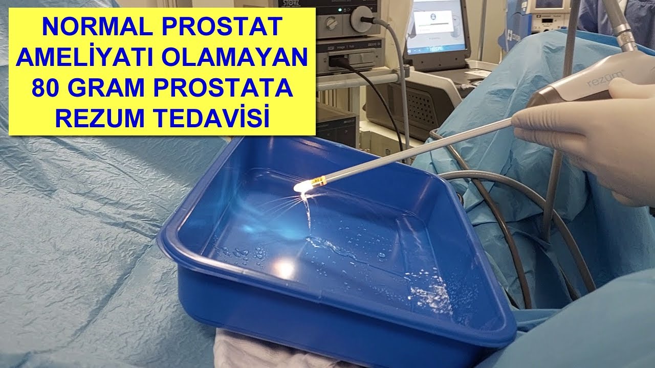 REZUM TEDAVİSİ Normal Prostat Ameliyatı Olamayacak Hastamızın 80 GRAM ...
