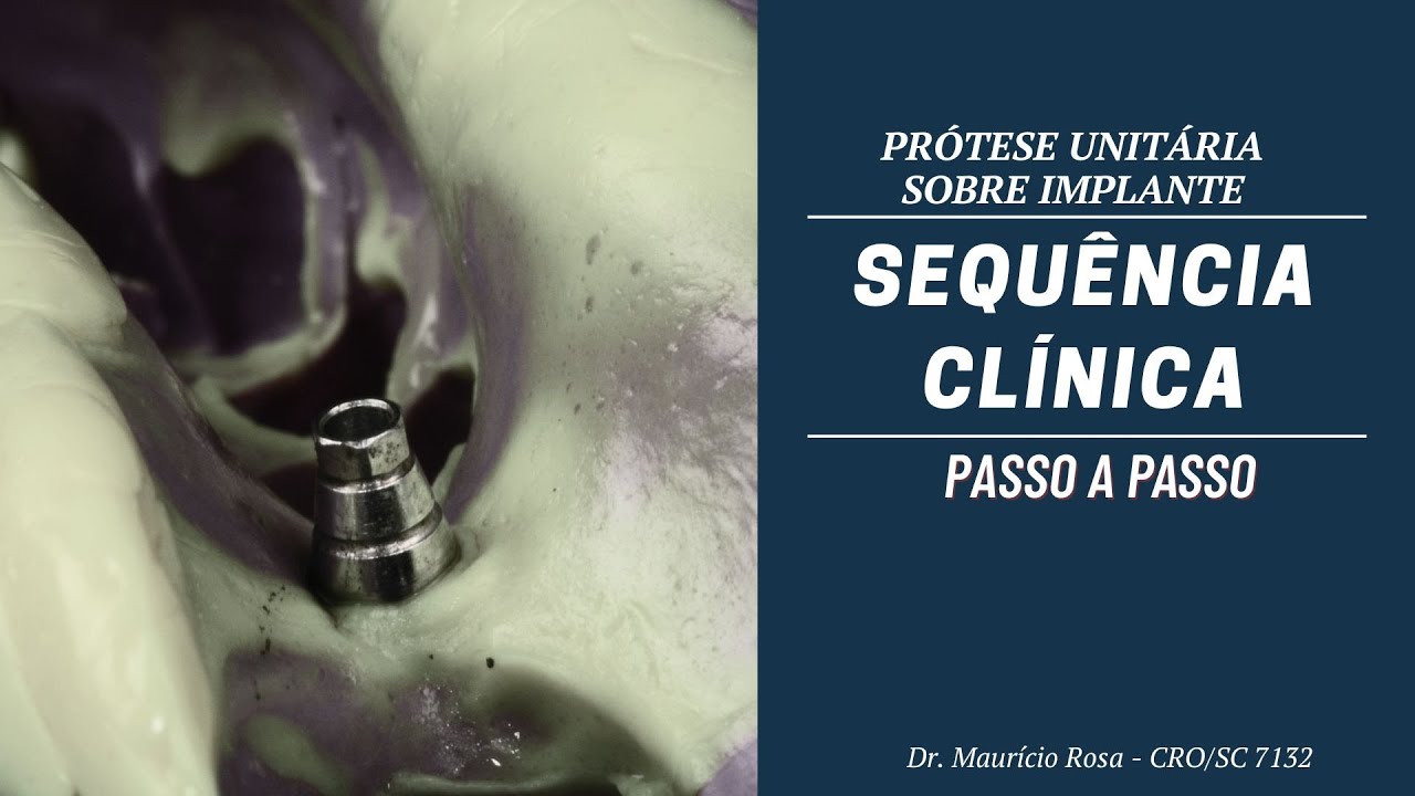 [SEQUÊNCIA CLÍNICA] Prótese sobre implantes - unitária parafusada passo ...