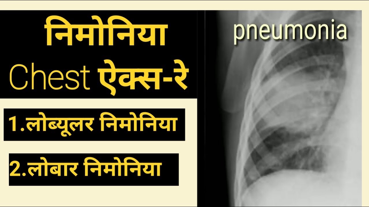 How To Read Chest X Ray Pneumonia Symptoms Pneumonia X Ray
