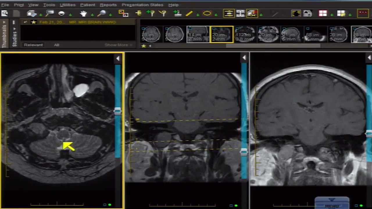 Schwannoma on brain MRI With Drs. Stephen Pomeranz and Malcolm Shupeck ...