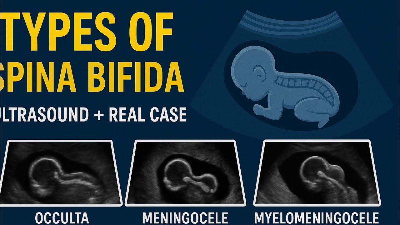 Spina Bifida on Ultrasound | Neural TubeDefect Explained | All 3 types ...