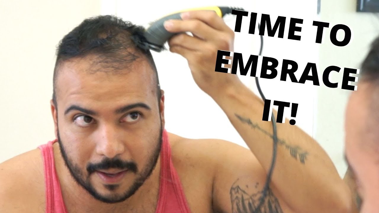 BALDING IN MY 30's - I'm Ready To Embrace Going Bald And OWN IT! - YouTube