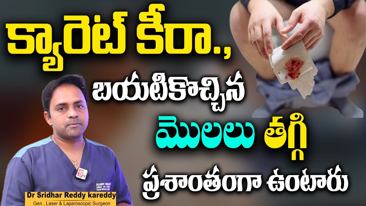 Dr Sridhar Reddy About Piles Diet | Cure Piles | Piles Treatment in ...