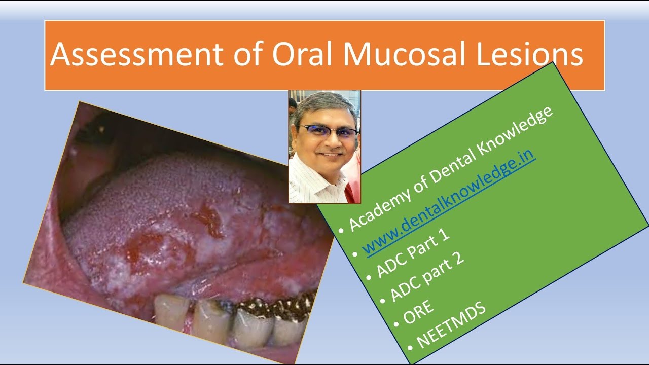 1017 Assessment of Oral Mucosal Diseases - YouTube