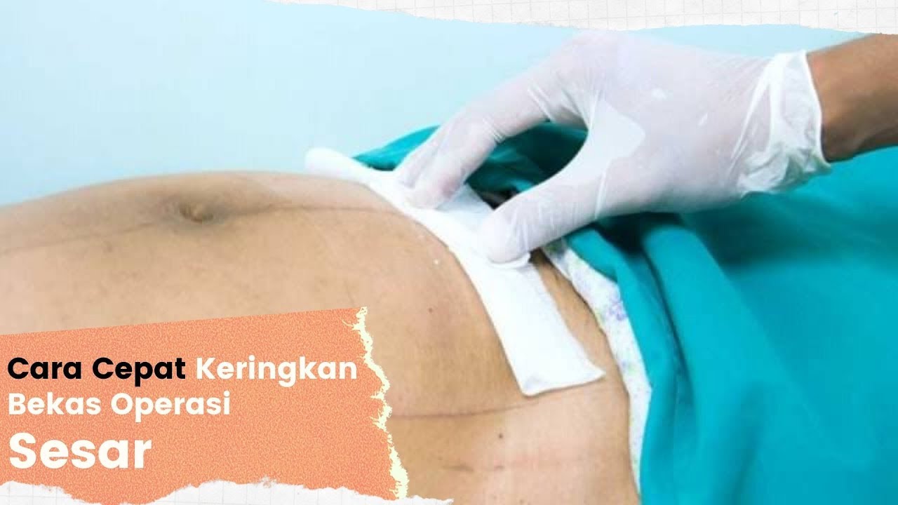 Ikan Gabus Untuk Obat Luka Operasi Caesar - YouTube