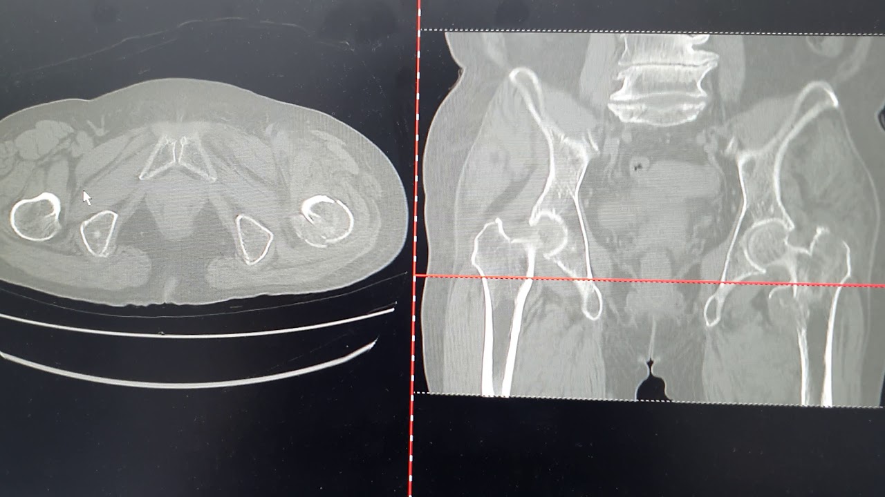 Hip CT fracture - YouTube