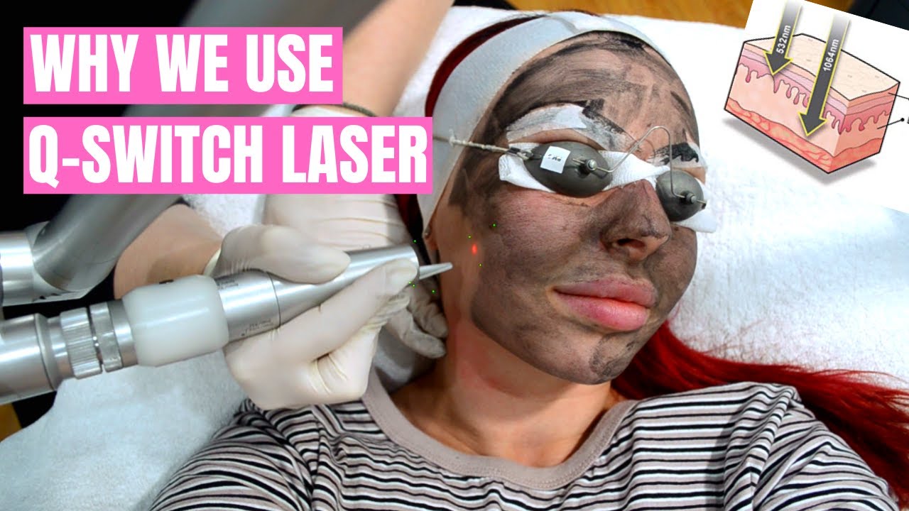 DERMAL TALKS: Why we use Q-switch Laser - YouTube