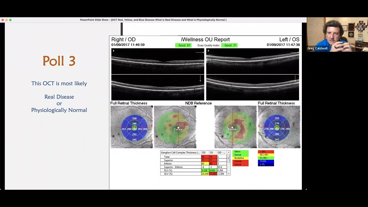 OCT Interpretation – Red Yellow and Blue Disease, What is Real Disease ...