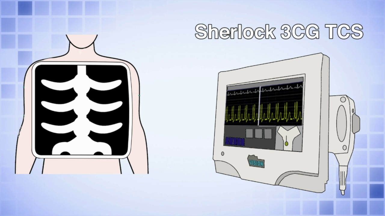 Comparison of chest X-ray and Sherlock 3CG™ TCS – Video Abstract ...