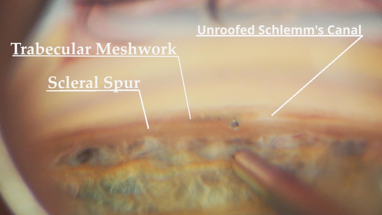 iStent insertion and MIGS surgery principles for glaucoma treatment in ...