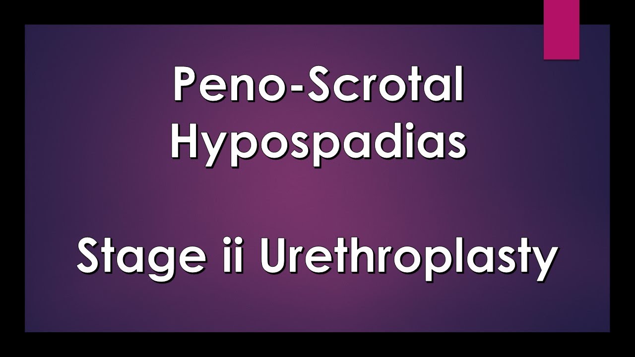 Stage two Urethroplasty with Tunica Vaginalis flap for penoscrotal ...
