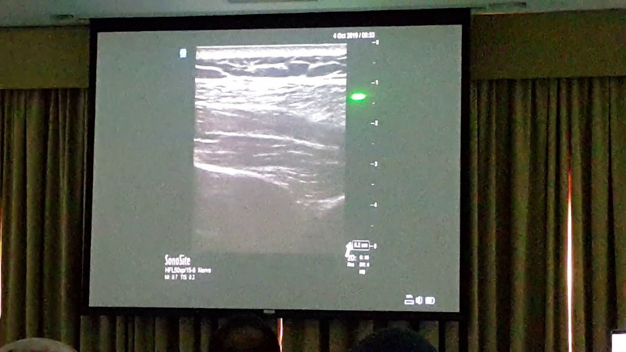 NYSORA Dubai 2019 USG Suprascapular Nerve Block - YouTube
