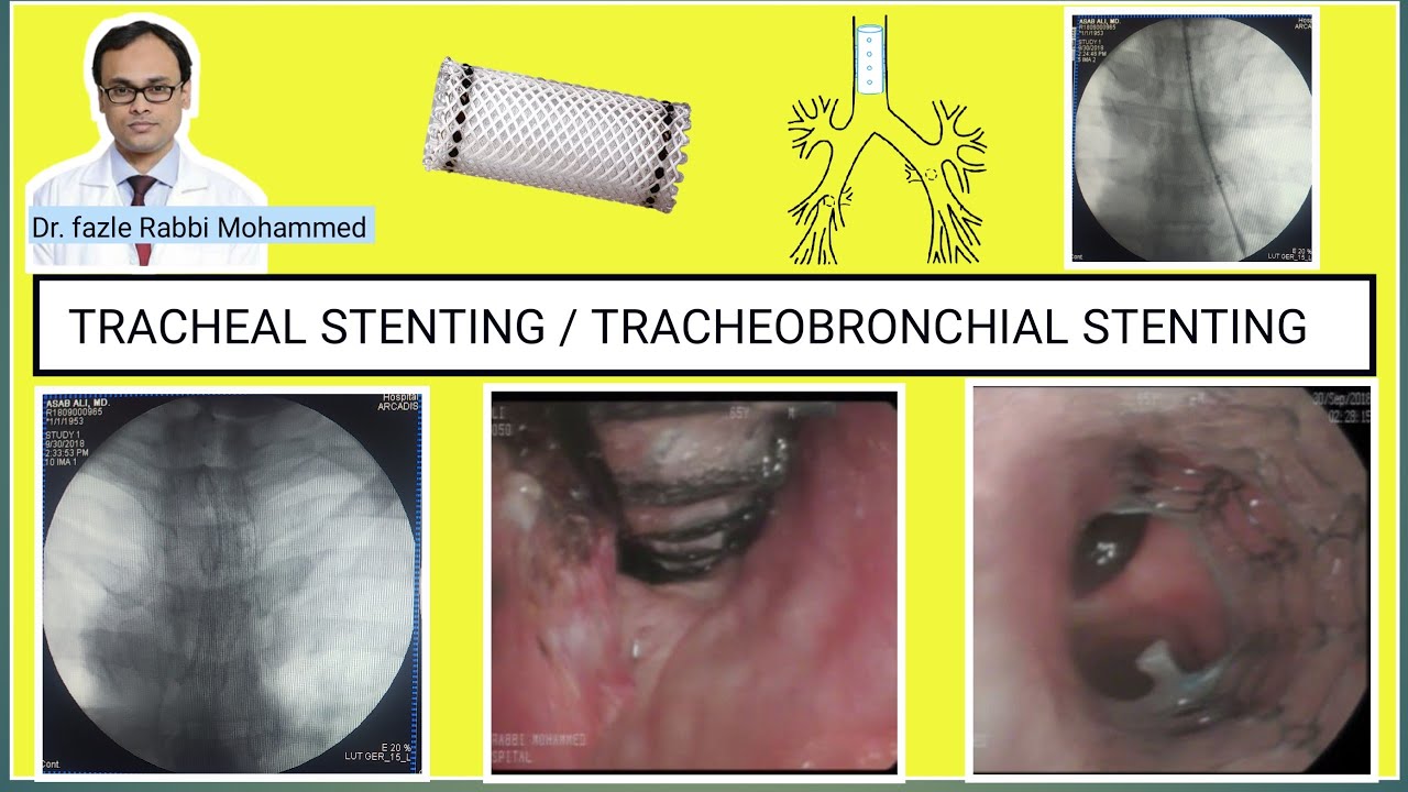 Tracheal stent placement at SQUARE HOSPITAL LTD Dhaka #BD_ENDOSCOPY ...