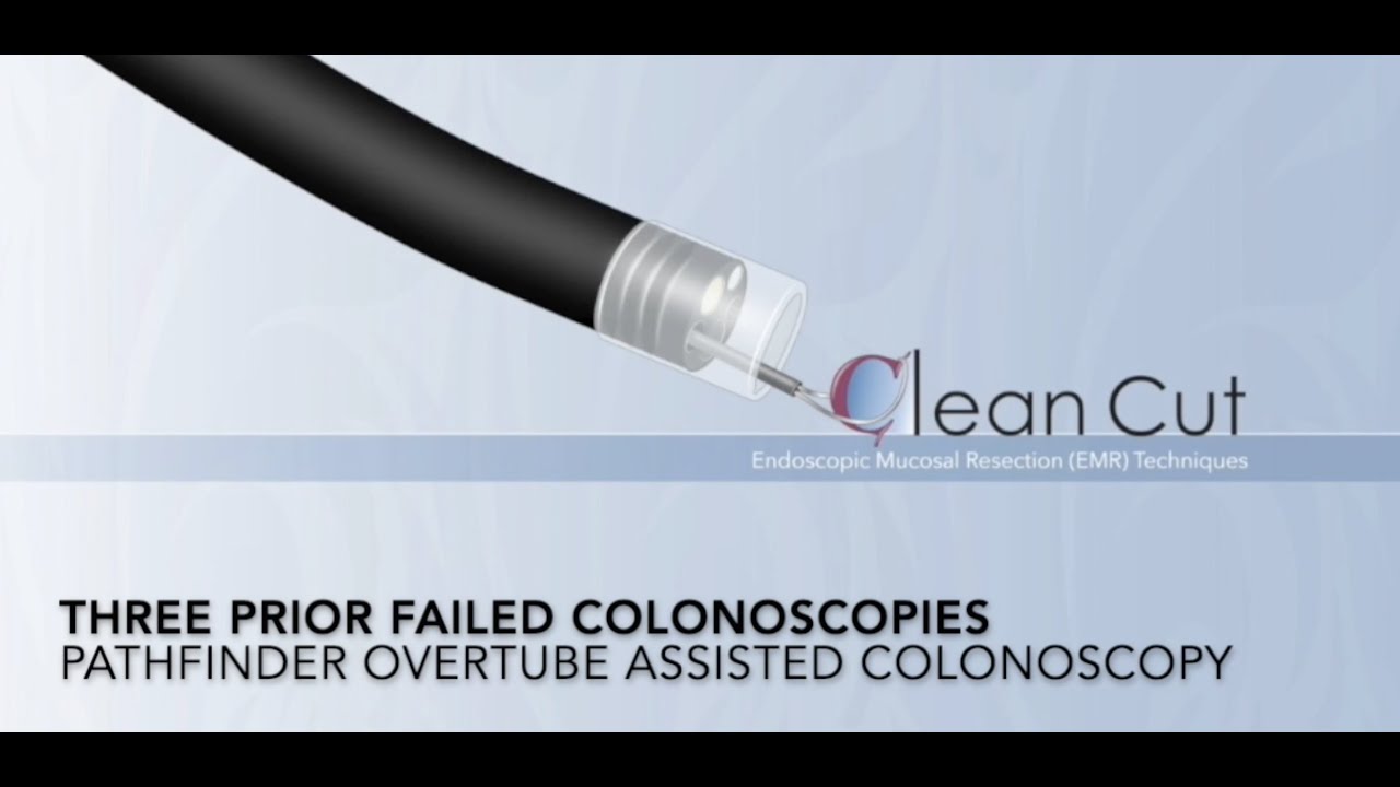 Colonoscopy using a PathFinder after Three Prior Failed Colonoscopies ...
