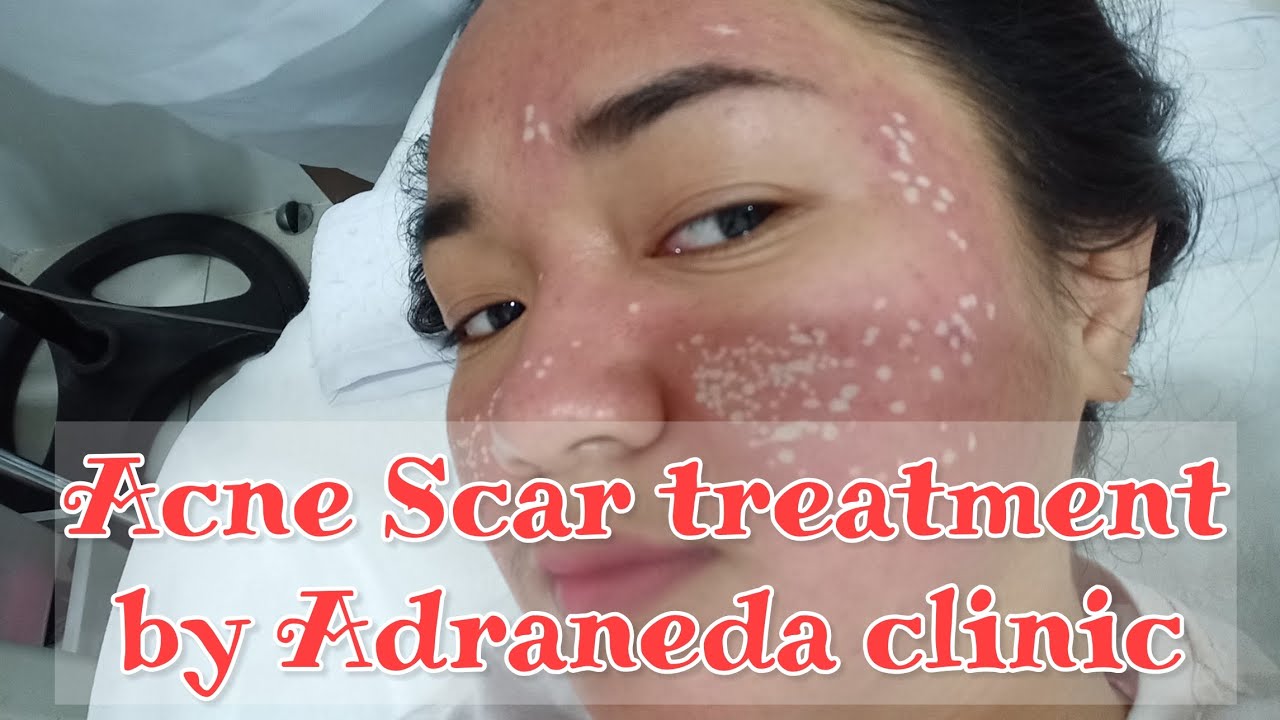 6th Session of FRACTIONAL RF with TCA cross/ACNE SCARS REMOVAL by ...