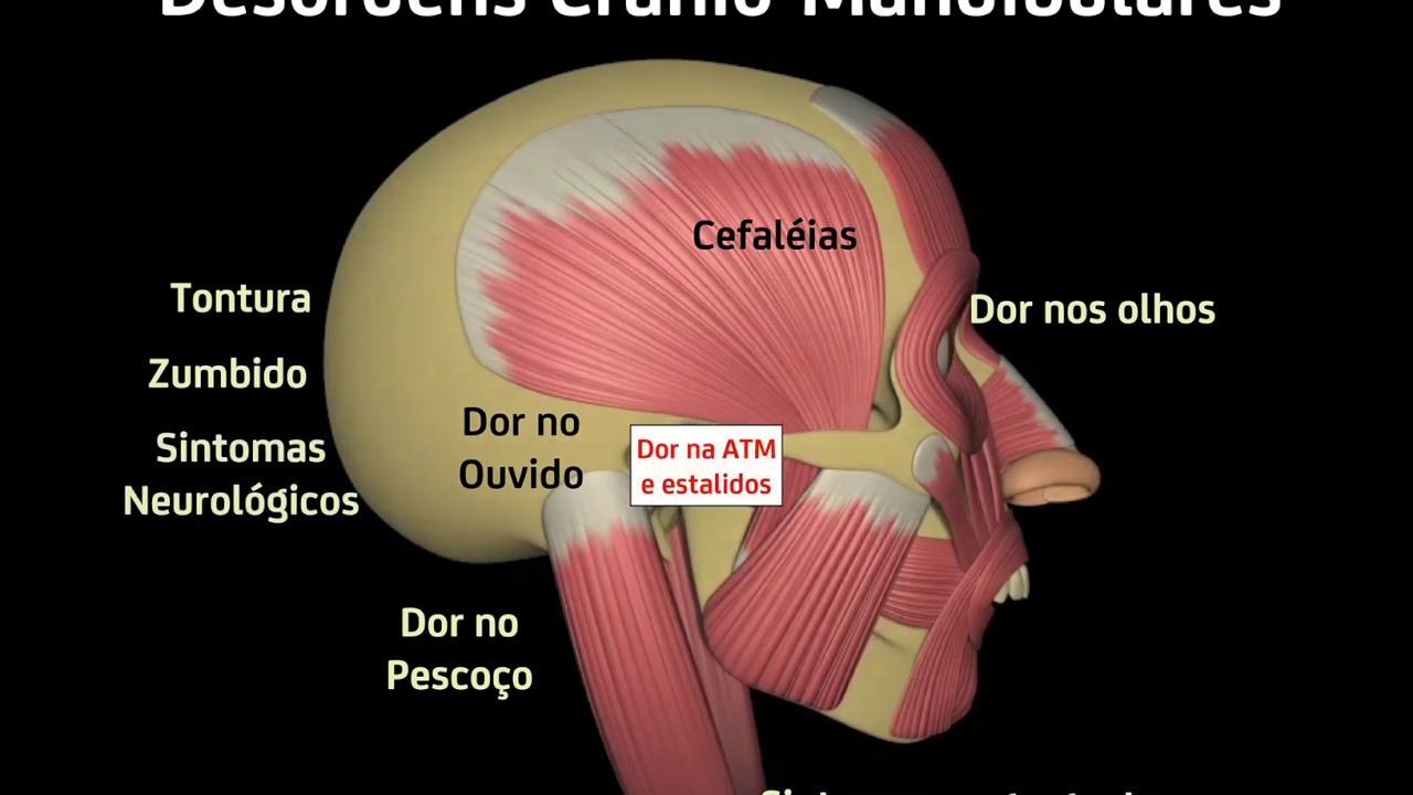 Sintomas de DTM. Desordens da Articulação Têmporo-Mandibular (ATM ...