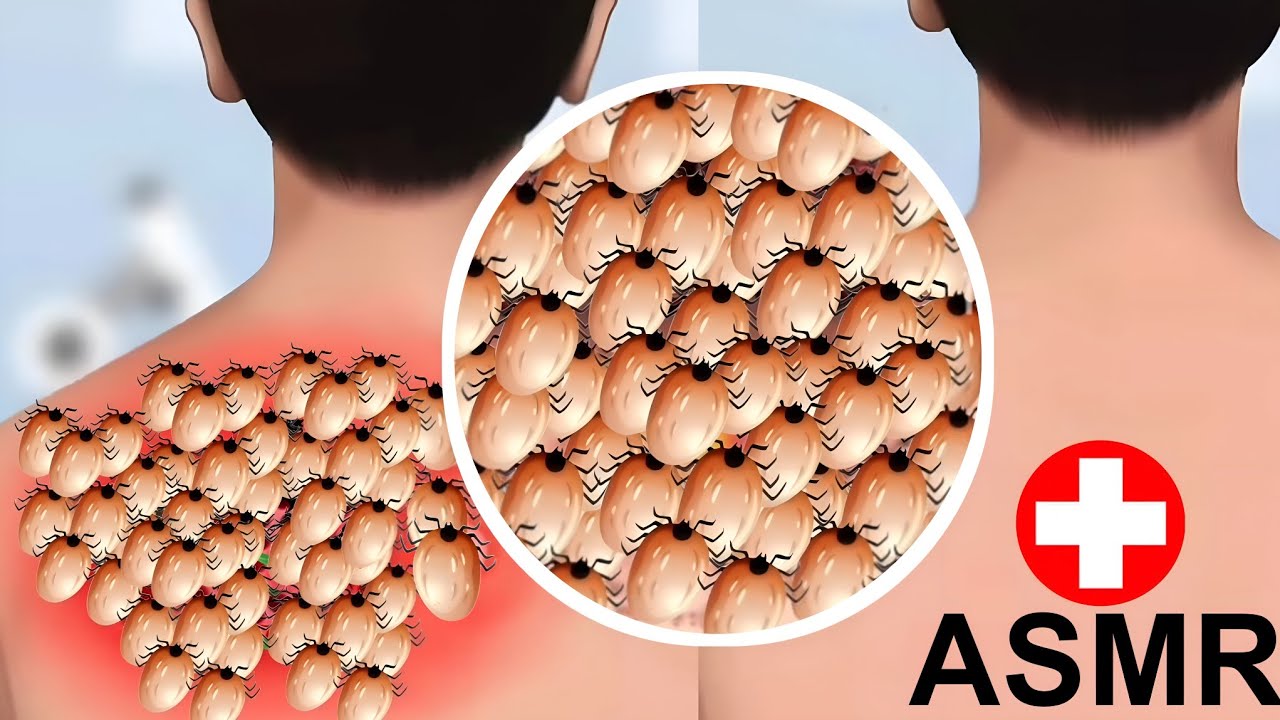 ASMR Treatment Of Maggots From Back | Ticks & Maggots Remove Animation ...