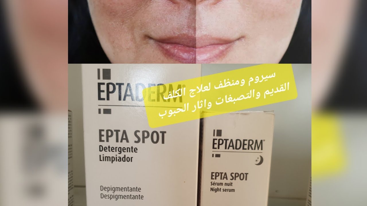 روتين جد فعال لعلاج الكلف القديم والتصبغات وأثار الحبوب👈 eptaderm epta ...