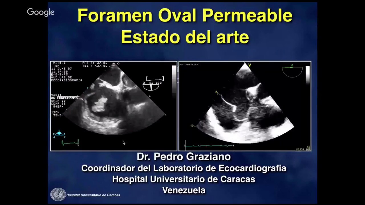 CardioImagen 2017 - Foramen Oval Permeable - Estado del Arte - Dr Pedro ...