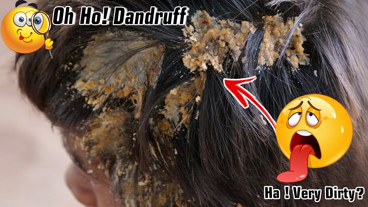Dandruff combing BIG FLAKES | removal Dandruff Flakes With Lice Comb ...