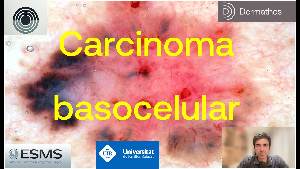 El cáncer de piel más frecuente: CARCINOMA BASOCELULAR - YouTube
