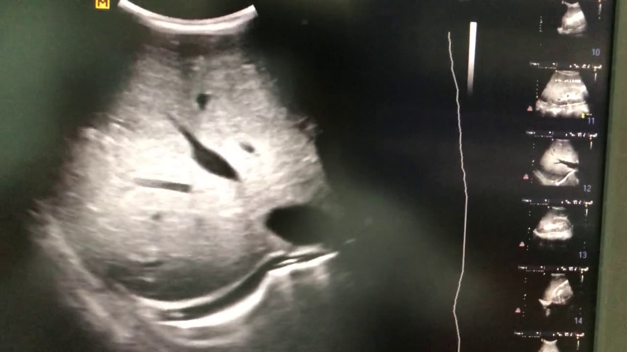 Ultrasound Findings of CCF an interesting case - YouTube
