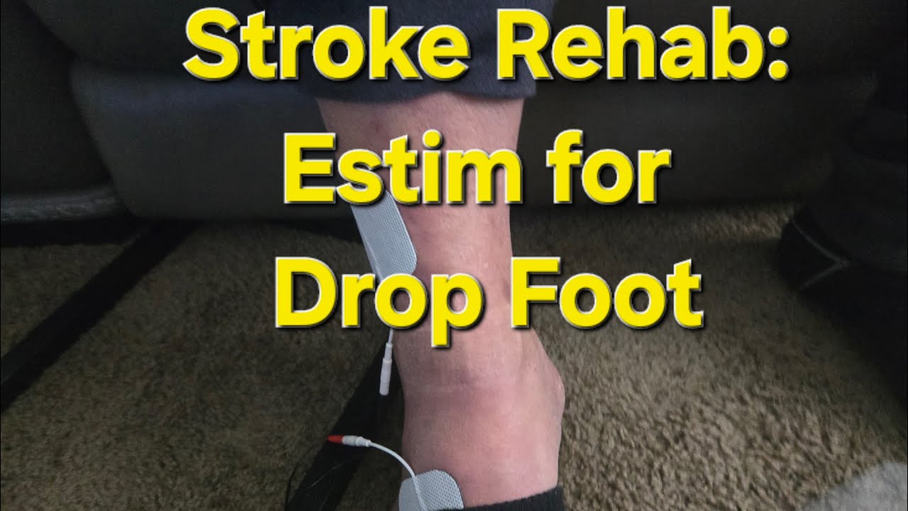 Stroke Rehab: Estim for Drop Foot from Physical Therapist - YouTube