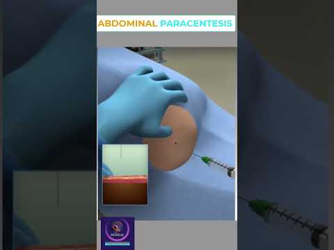Abdominal Paracentesis Procedure #shorts
