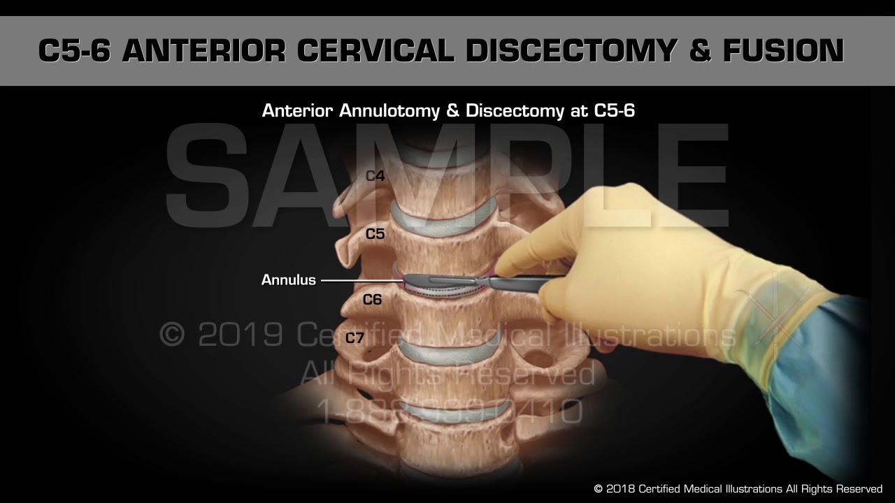 Anterior Cervical Discectomy & Fusion at C5-6 - Medical Animation - YouTube