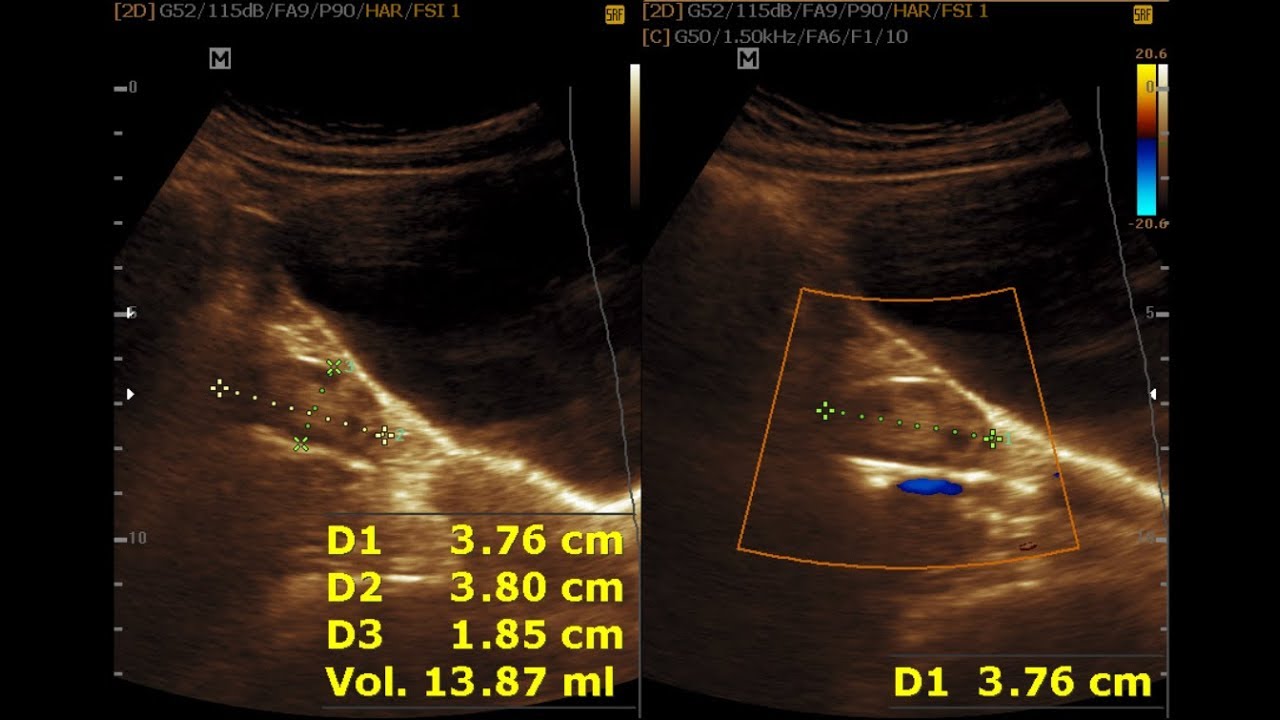 Poly cystic ovary - YouTube
