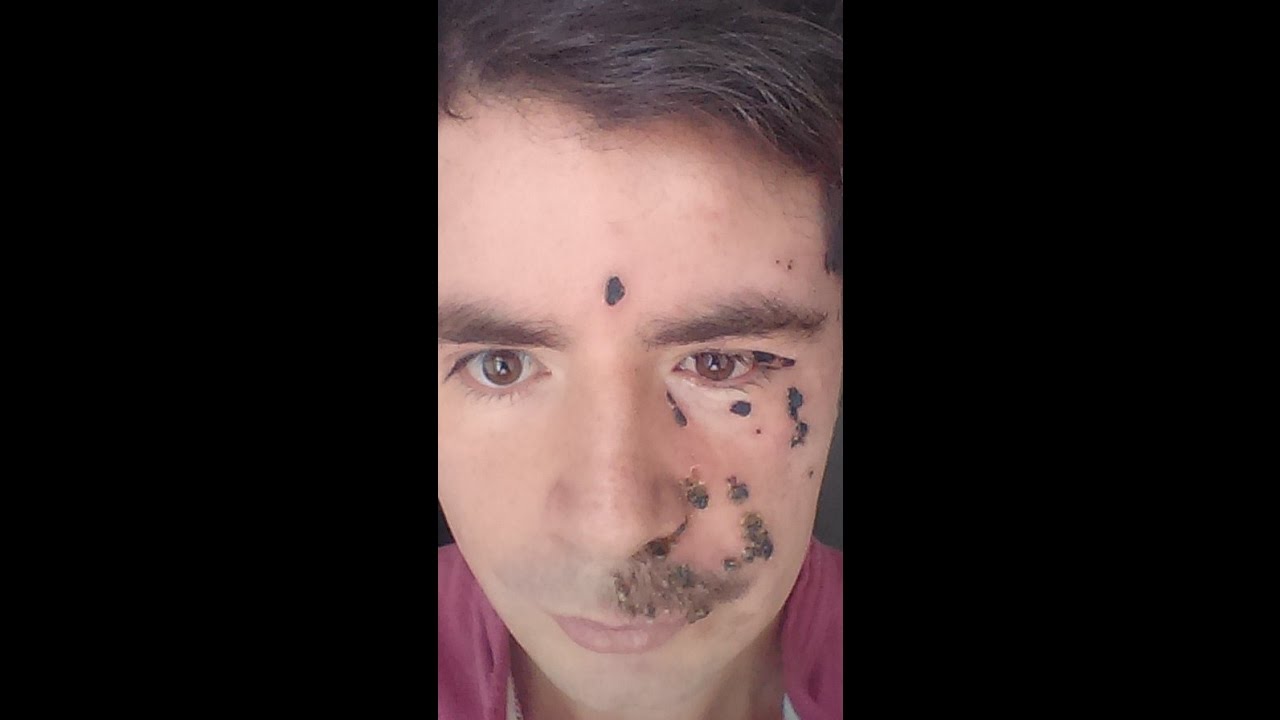 CICATRICES DE LA VARICELA como aliviarlas LA ROCHE POSAY - YouTube