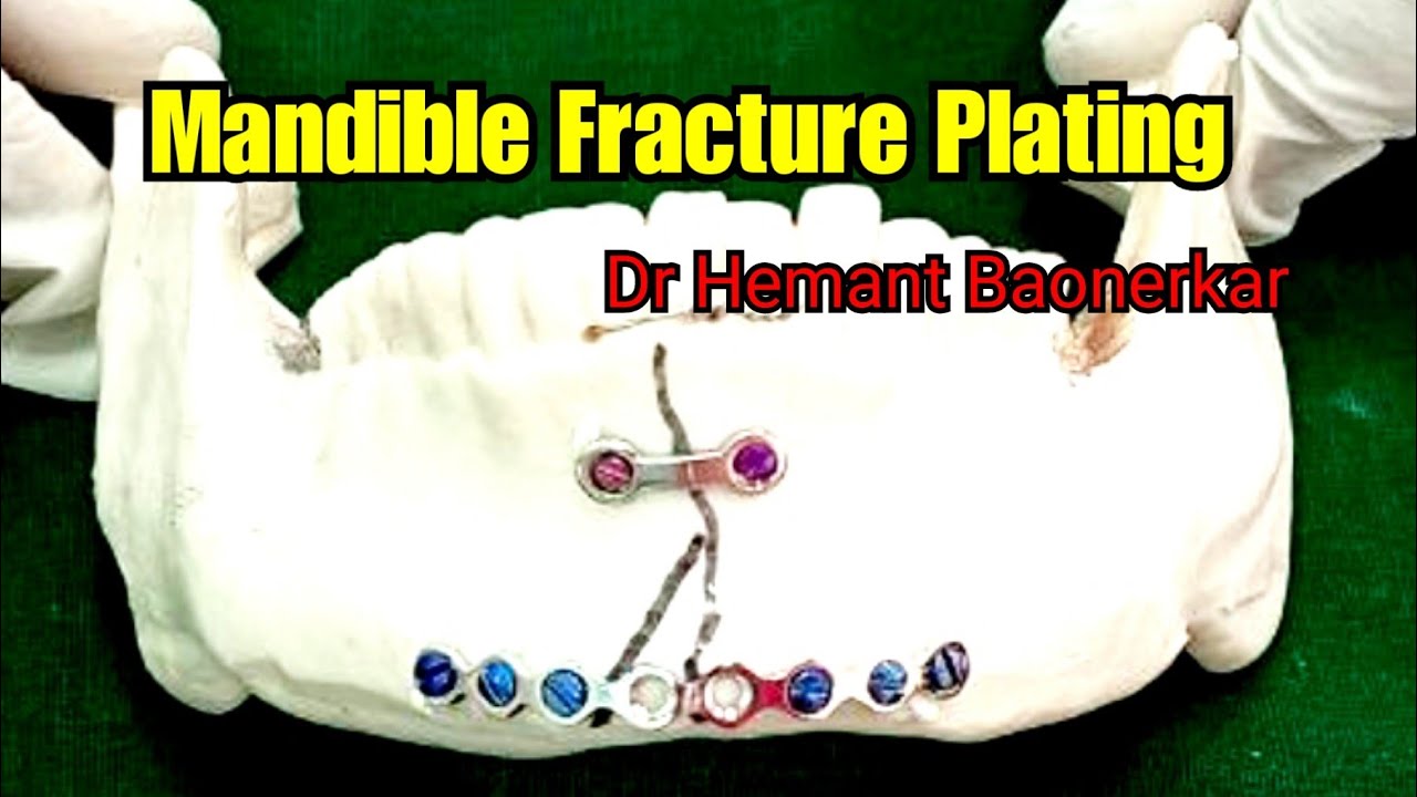 Mandible Fracture Plating - YouTube