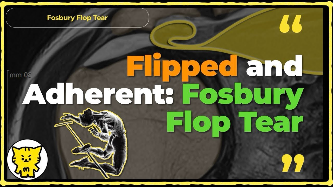 Flipped and Adherent: Fosbury Flop Tear_Full-thickness rotator cuff ...