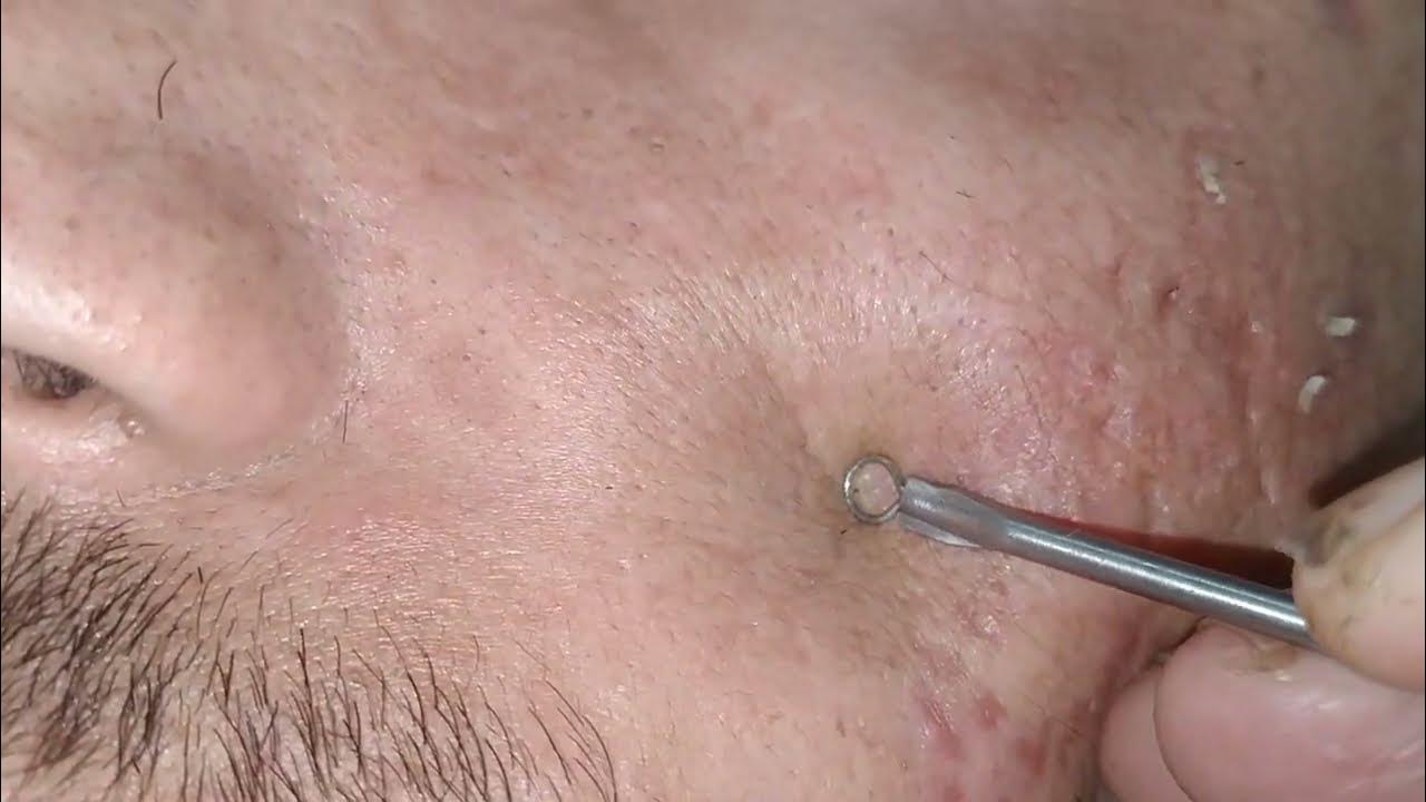 blackheads removal with everyday sac dep Spa | sac dep Spa face treatments 2023 | sac dep Spa ...