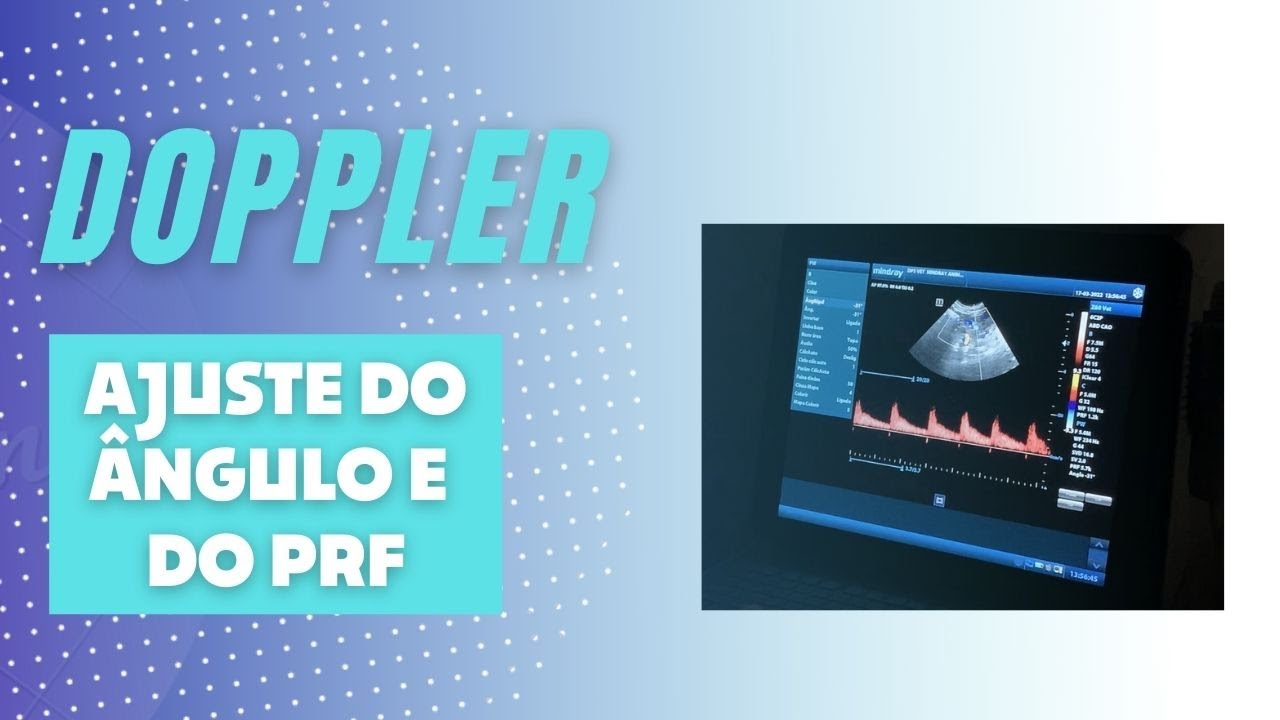 A importância do ajuste do ângulo e do PRF no mapeamento Doppler - YouTube