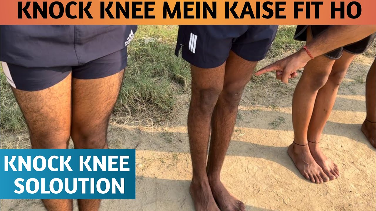 Knock Knee में फीट कैसे हो 75% लोग फेल होते है [ मेडिकल चेकअप में यह ...