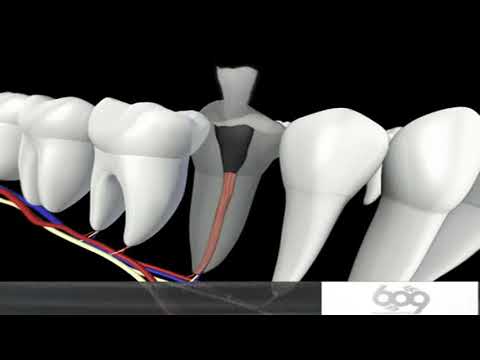 Root Canal Procedure 3D Animation Endodontics Los Angeles - YouTube